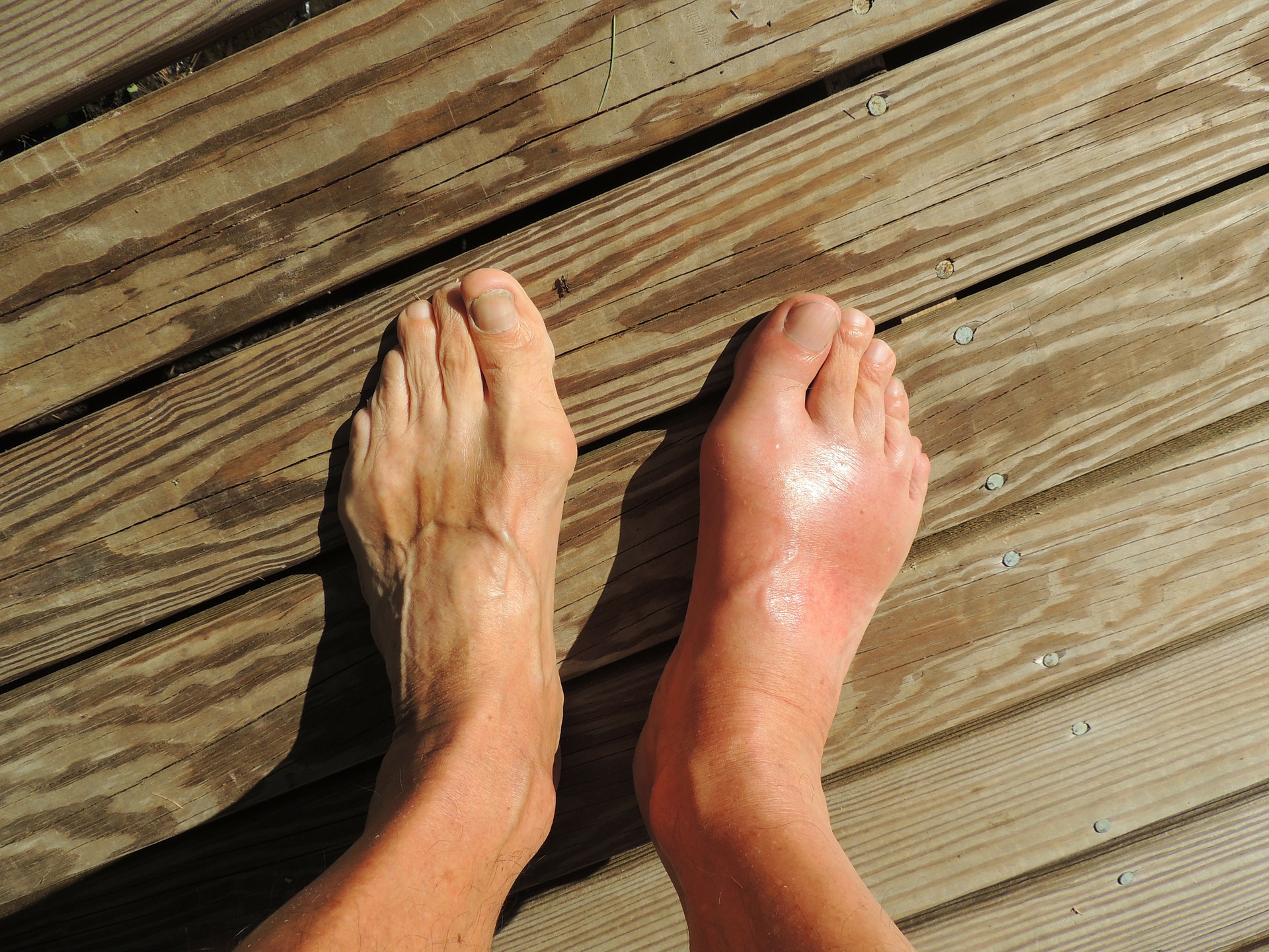 La vraie raison pour laquelle vos chevilles et vos pieds peuvent tre gonfls